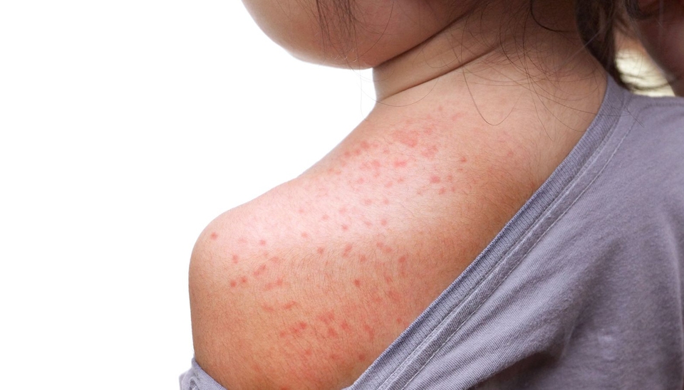 Common Rashes in Children | www.justmommies.com